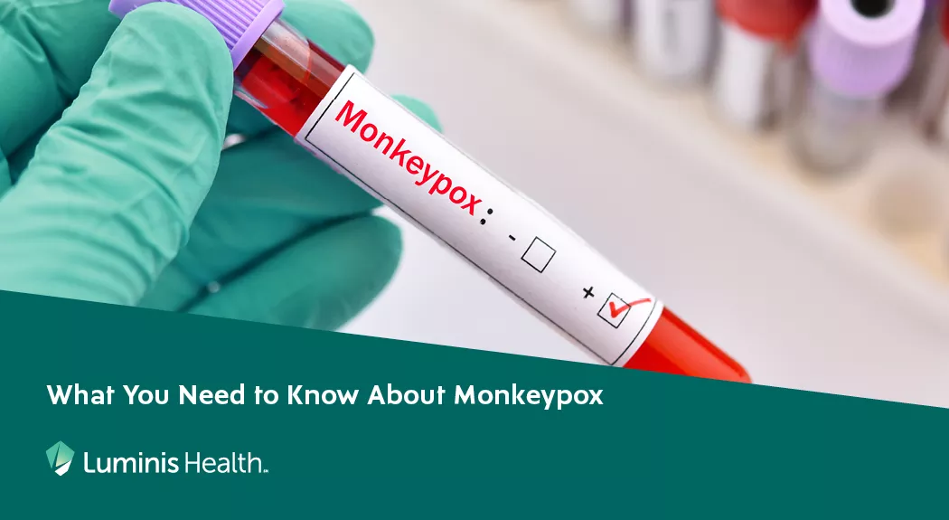 Monkeypox: What You Need To Know | Luminis Health