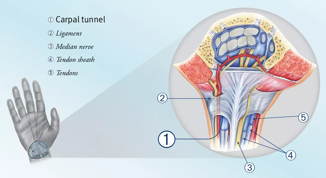 Understanding Carpal Tunnel Syndrome | Luminis Health